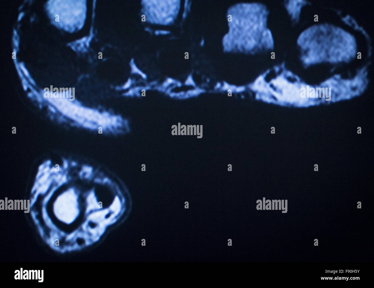 MRI magnetic resonance imaging medical scan test results of foot and ...