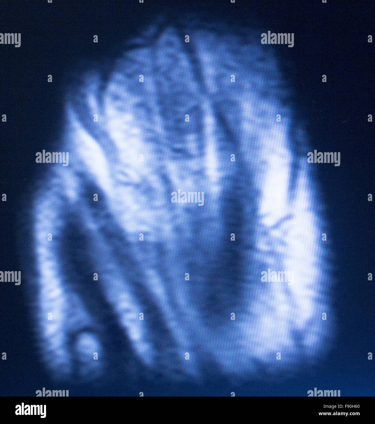 MRI magnetic resonance imaging medical scan test results of hand and ...