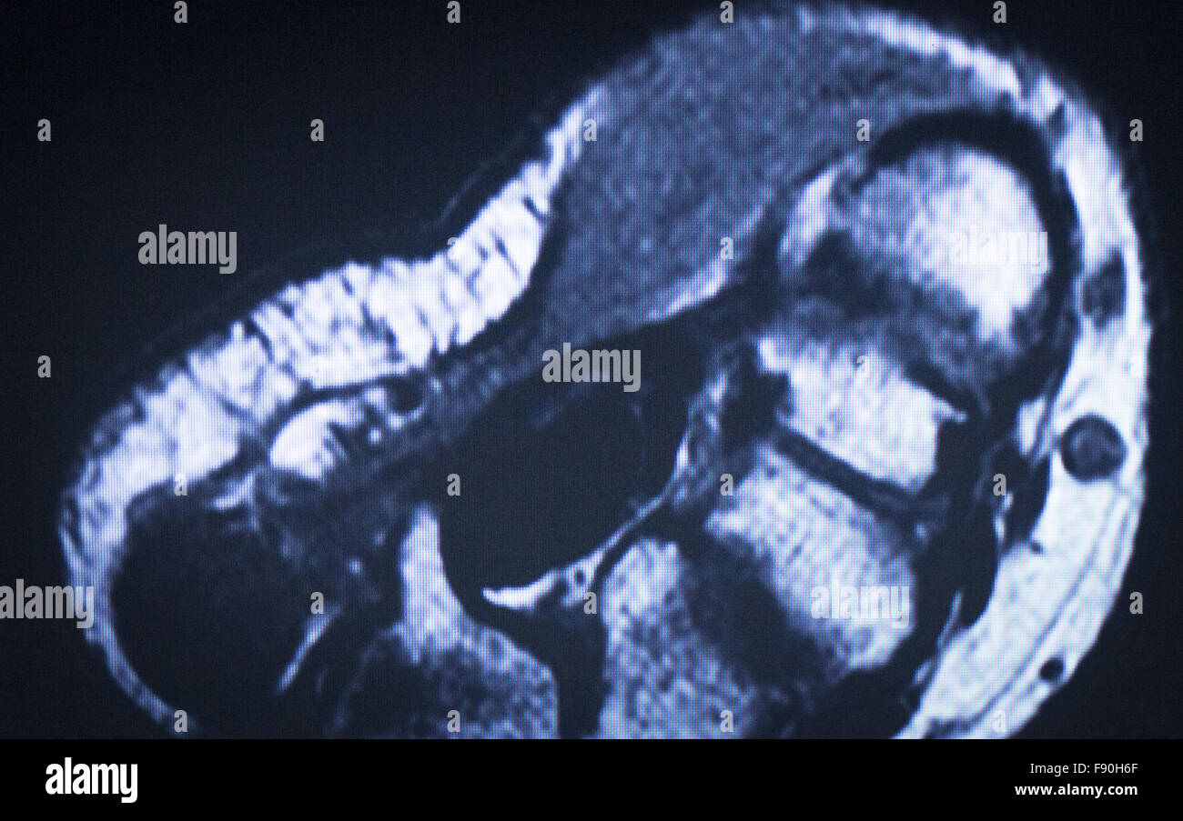 MRI magnetic resonance imaging medical scan test results of foot and ...