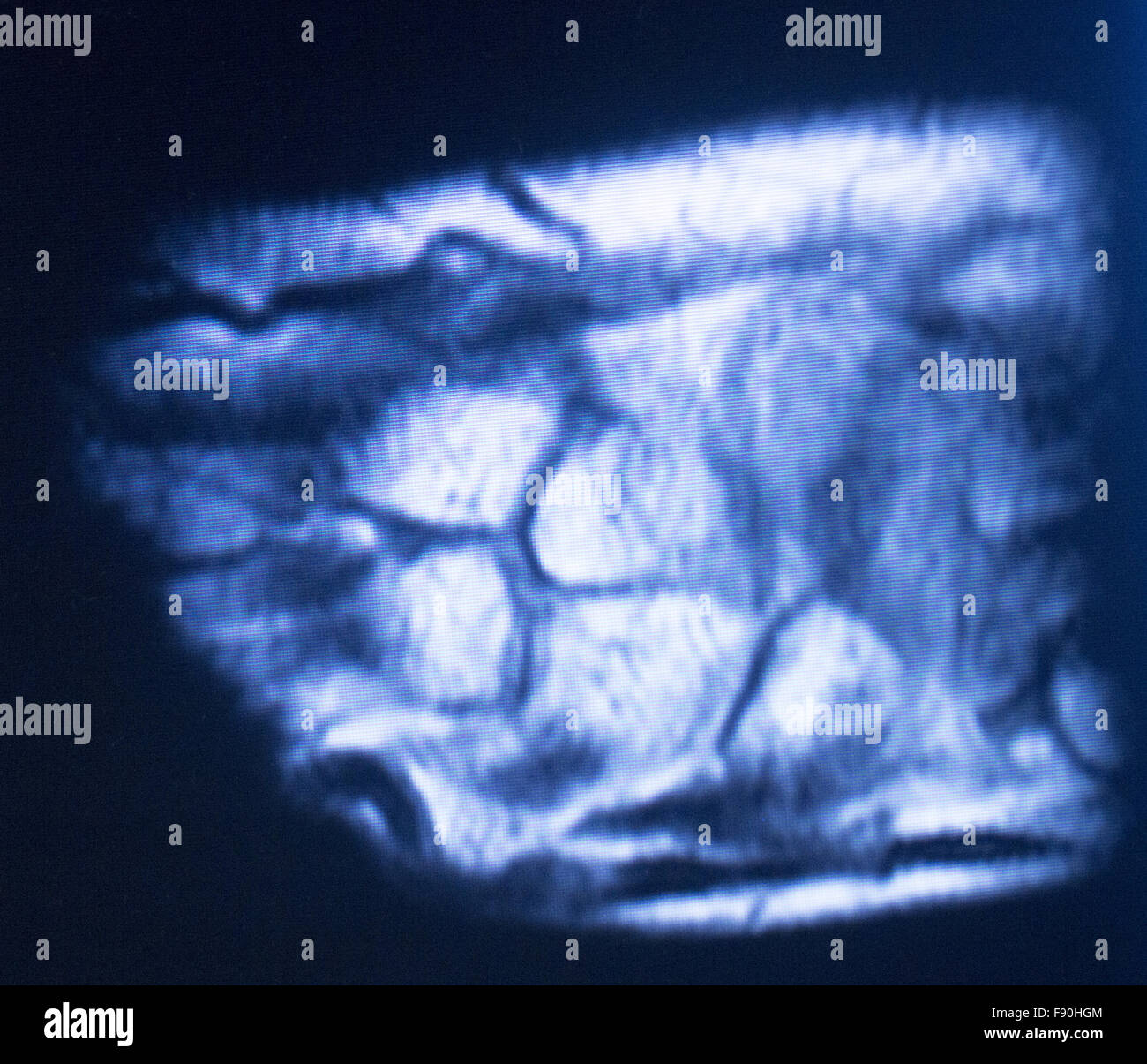 MRI magnetic resonance imaging medical scan test results of hand and ...