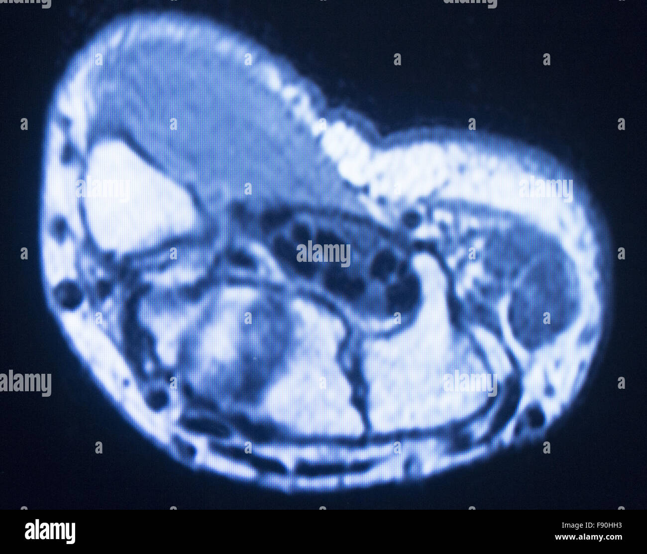MRI magnetic resonance imaging medical scan test results of hand and ...