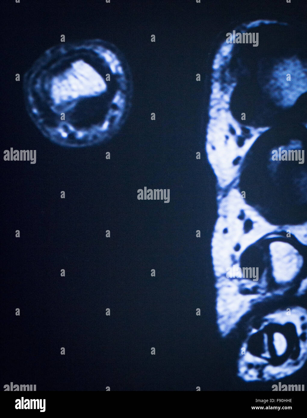 MRI magnetic resonance imaging medical scan test results of foot and ...