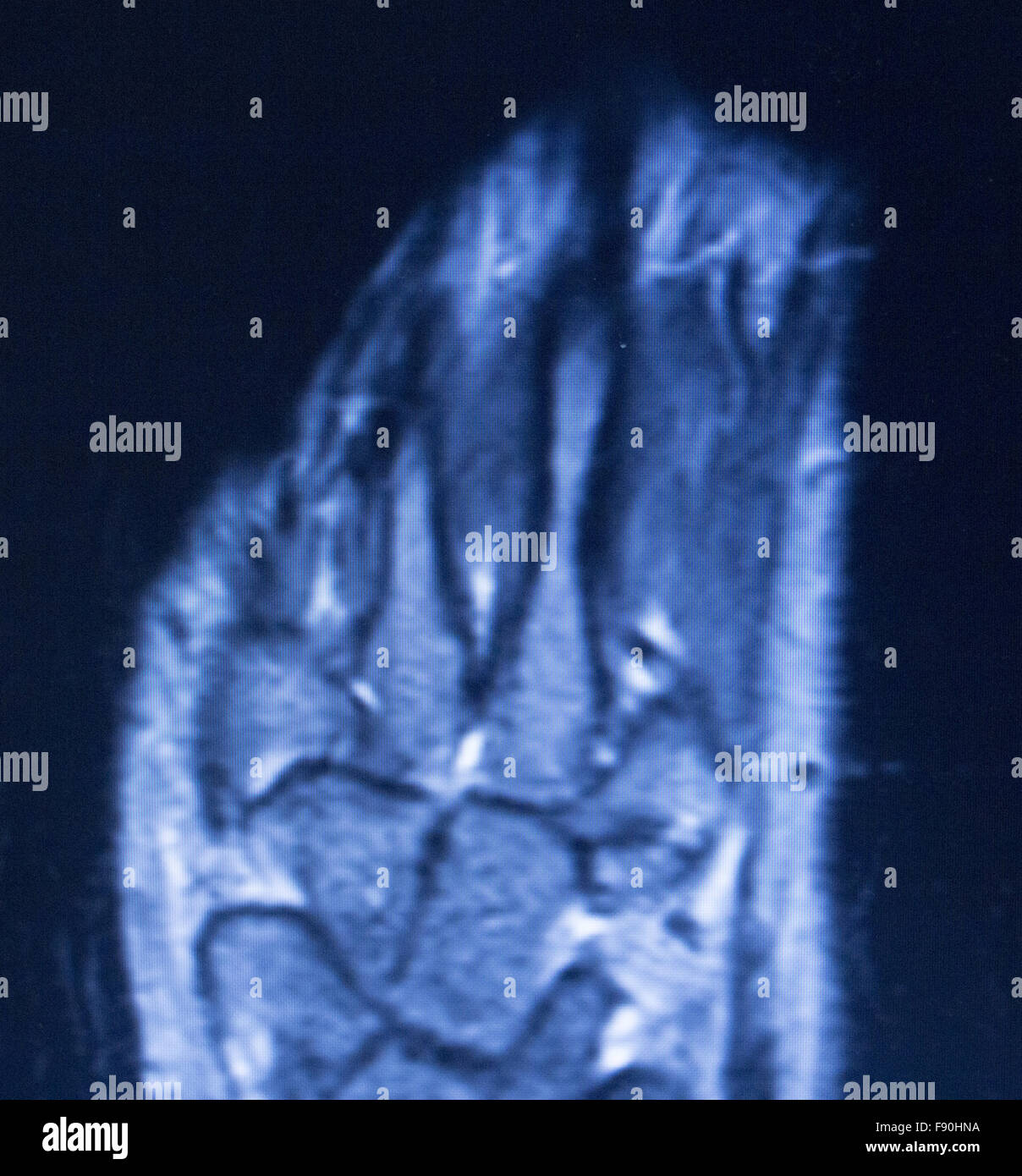 MRI magnetic resonance imaging medical scan test results of hand and ...