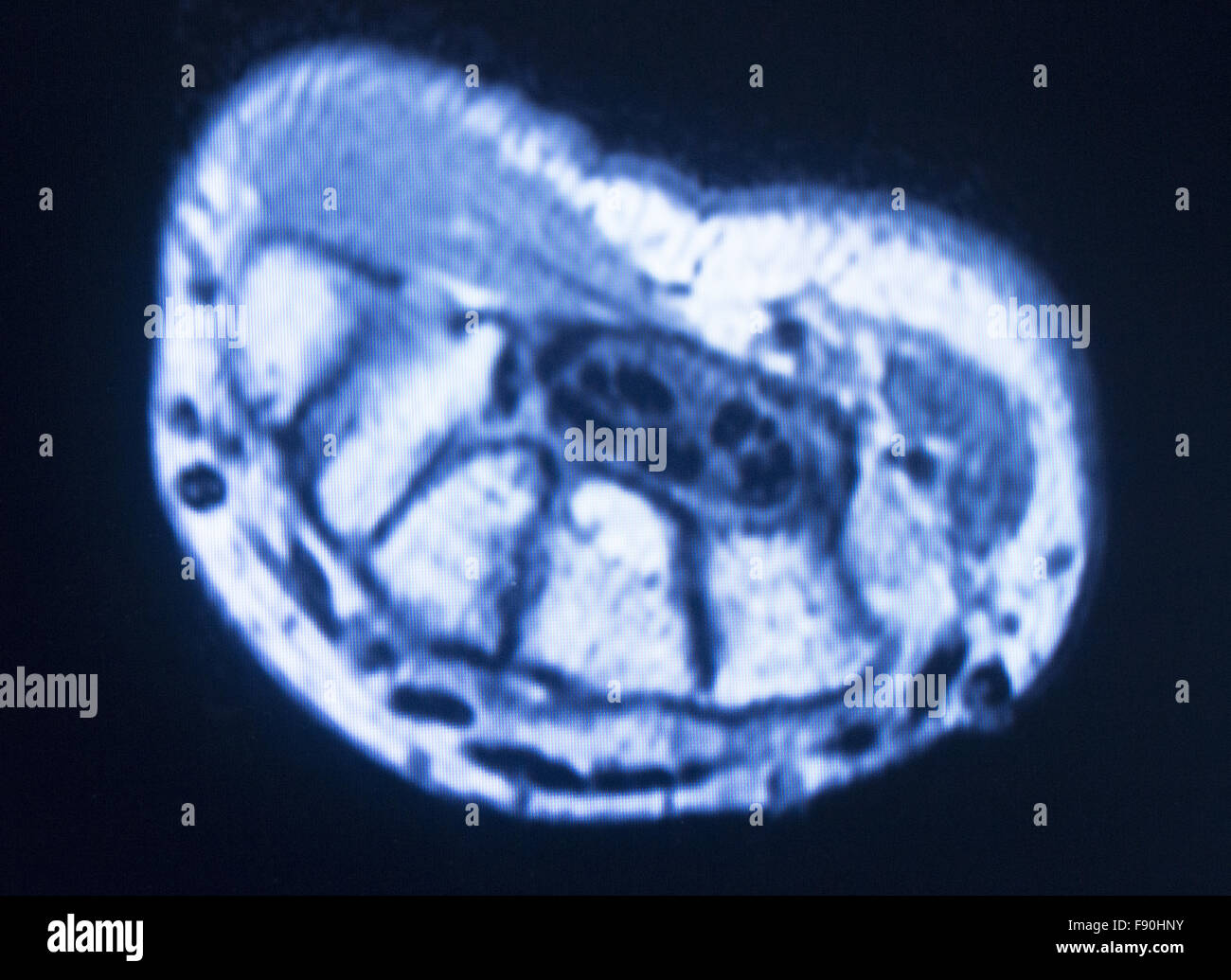 MRI magnetic resonance imaging medical scan test results of hand and ...