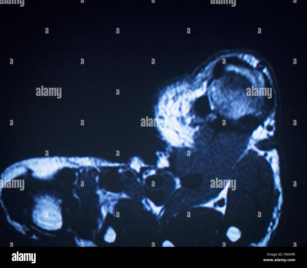 MRI magnetic resonance imaging medical scan test results of foot and ...