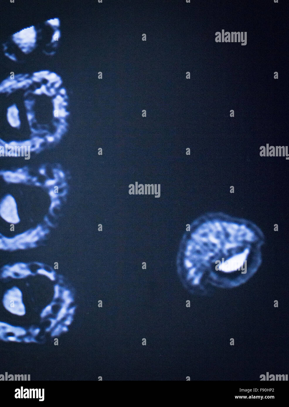 MRI magnetic resonance imaging medical scan test results of foot and ...