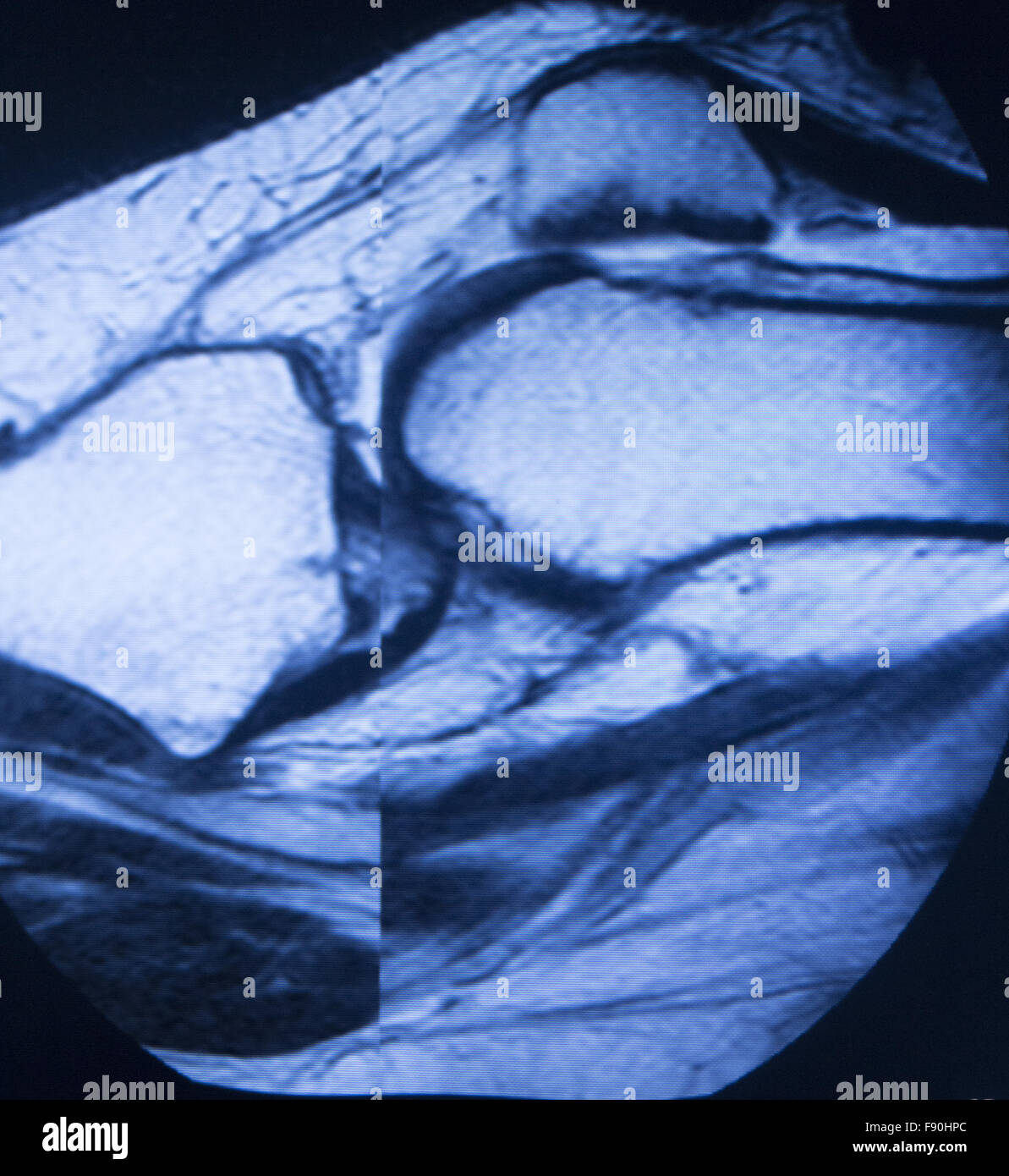 MRI magnetic resonance imaging medical scan test results showing knee ...