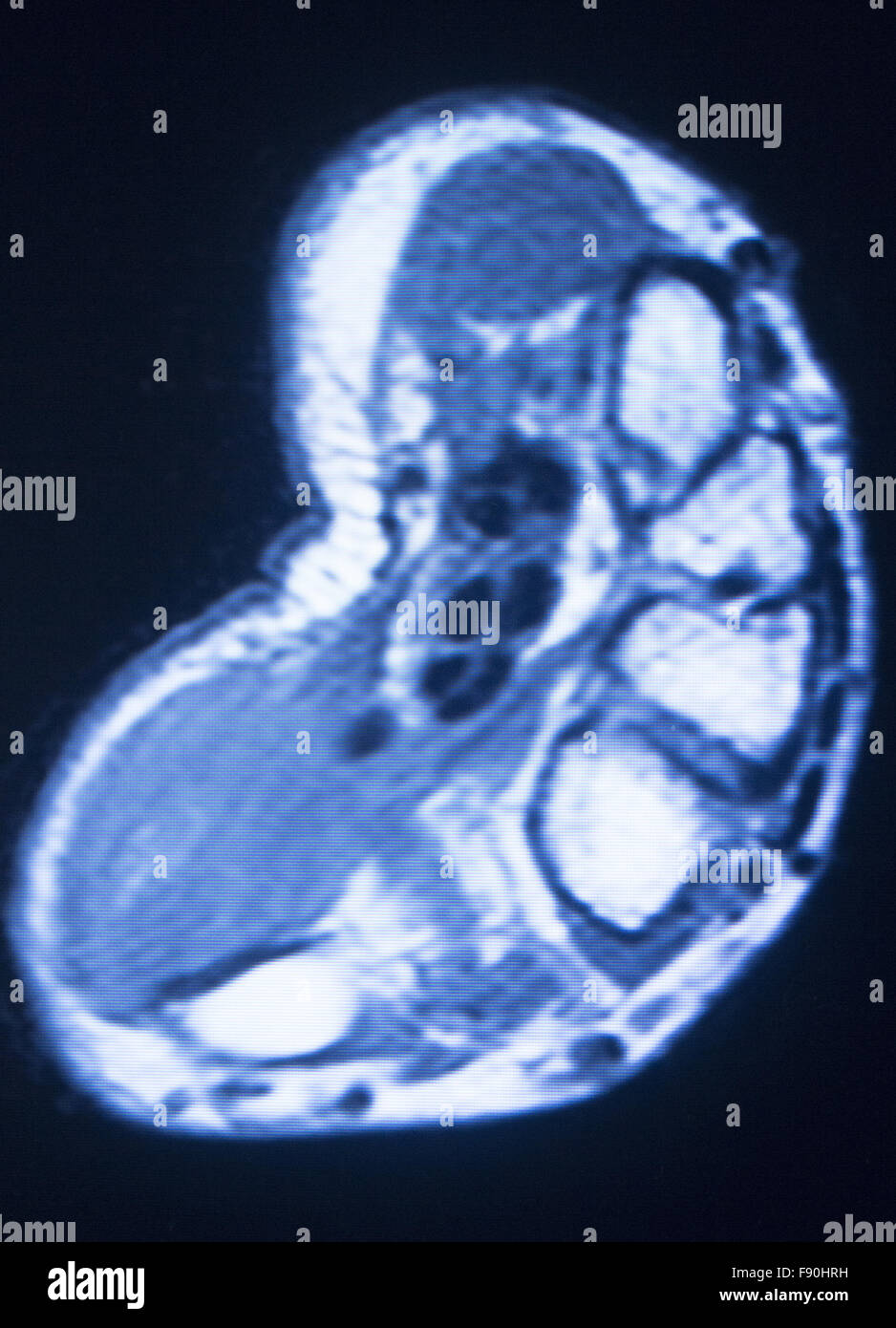 MRI magnetic resonance imaging medical scan test results of hand and ...