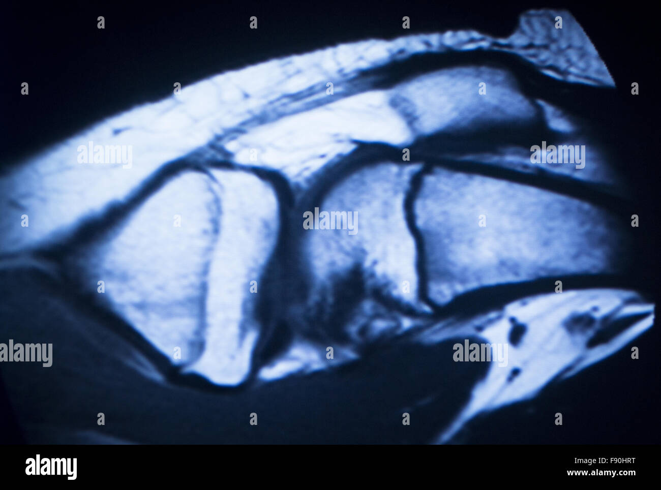 MRI magnetic resonance imaging medical scan test results showing knee ...