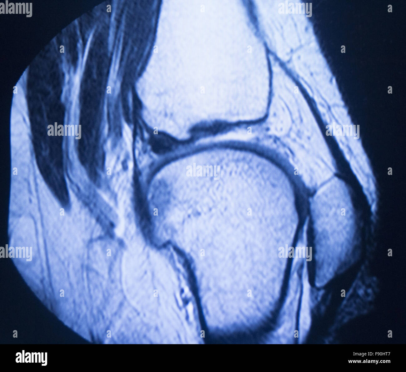 MRI magnetic resonance imaging medical scan test results showing knee ...