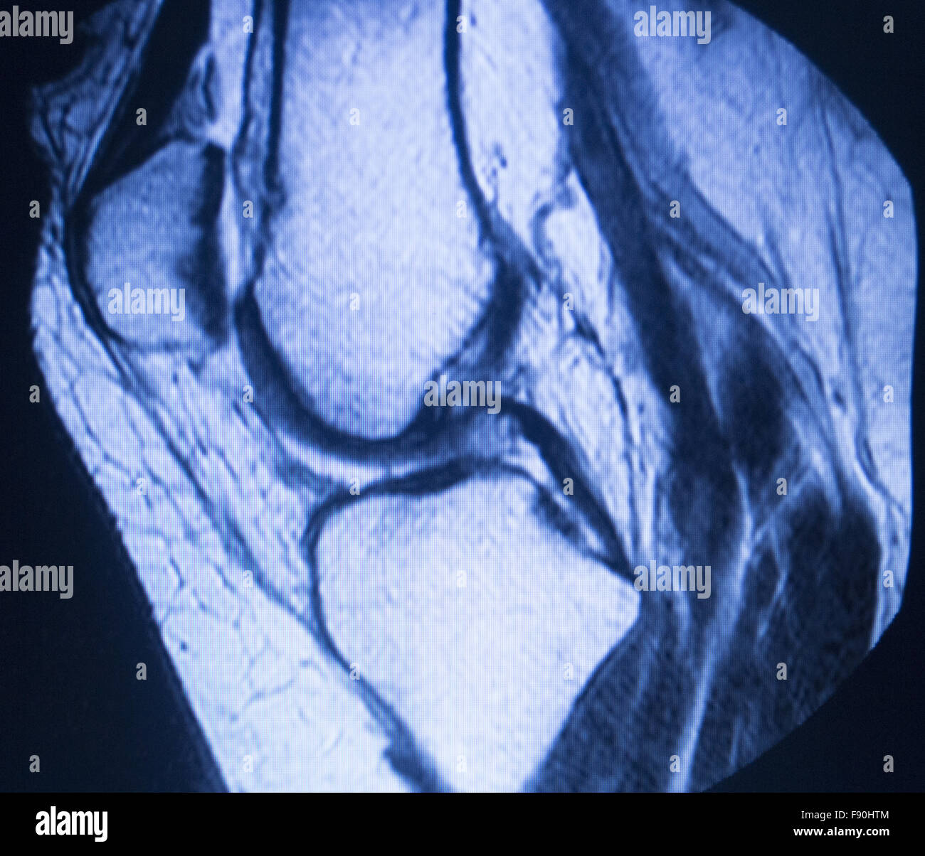 MRI magnetic resonance imaging medical scan test results showing knee ...