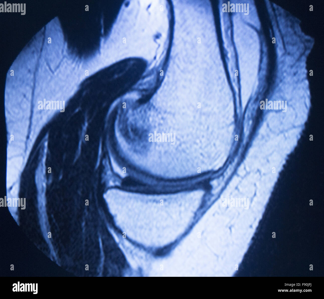 MRI magnetic resonance imaging medical scan test results showing knee ...