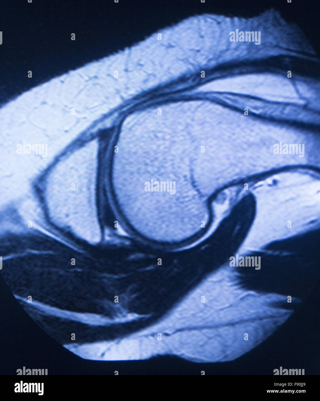 MRI magnetic resonance imaging medical scan test results showing knee ...