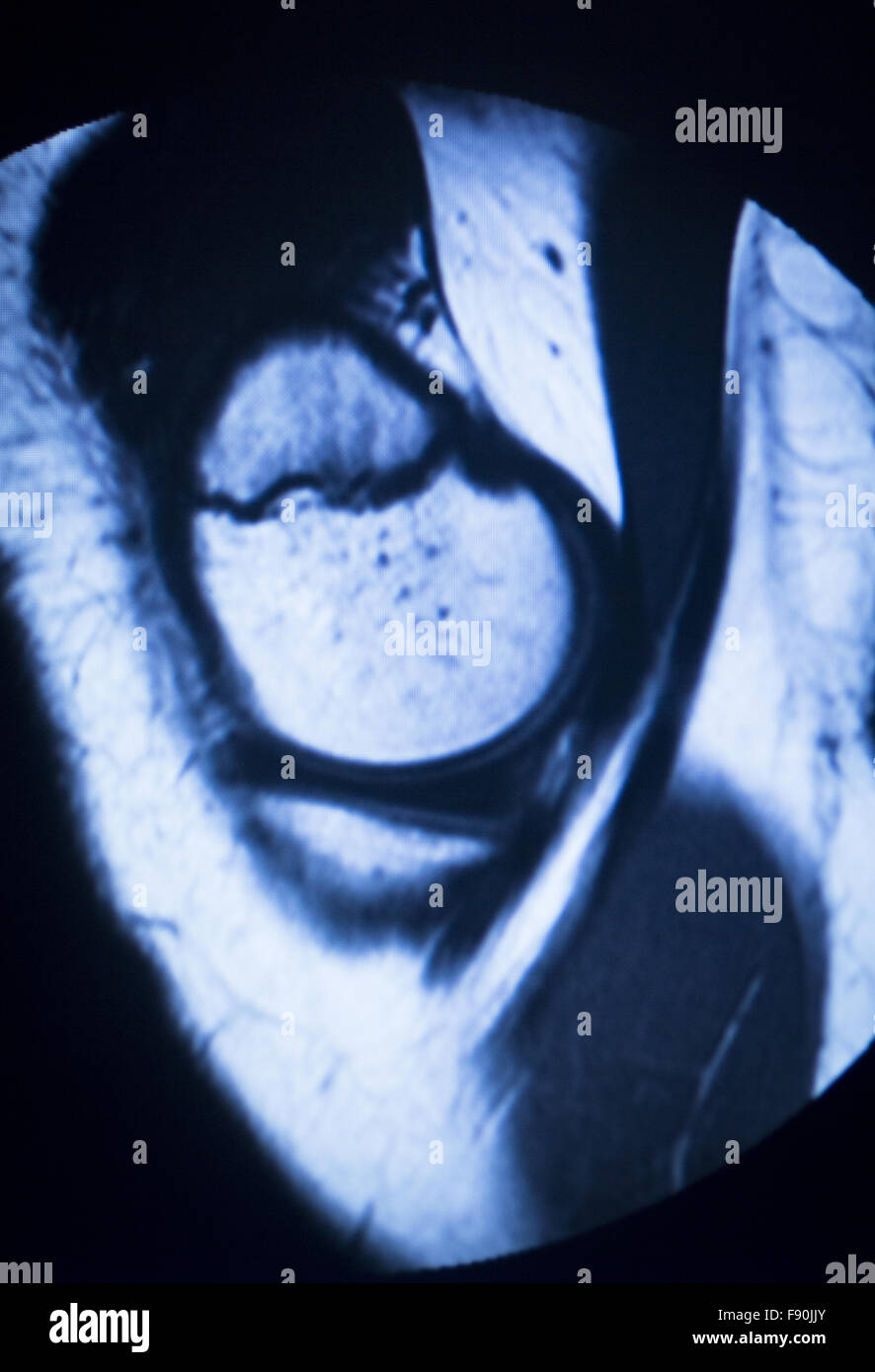 MRI magnetic resonance imaging medical scan test results showing knee ...