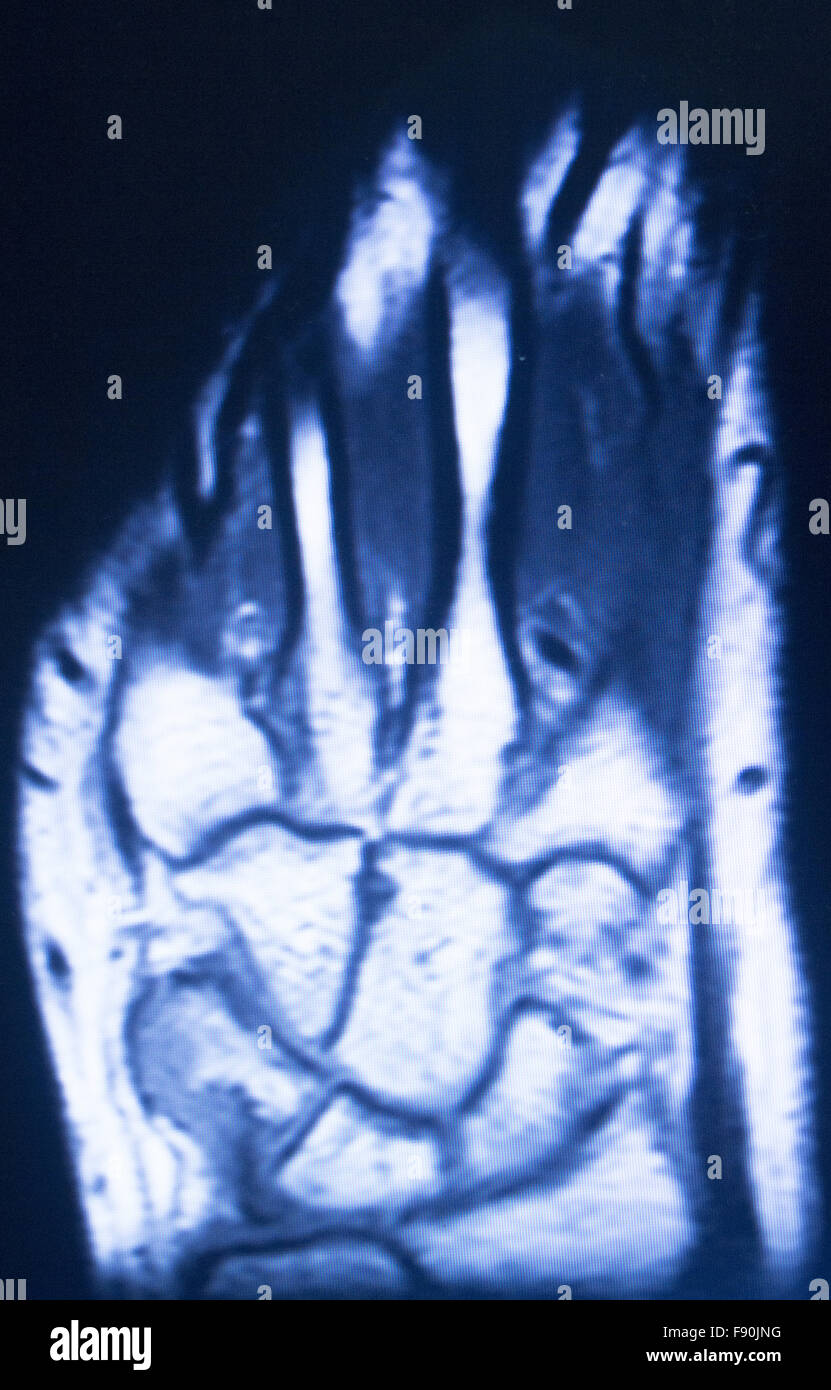 MRI magnetic resonance imaging medical scan test results of hand and ...