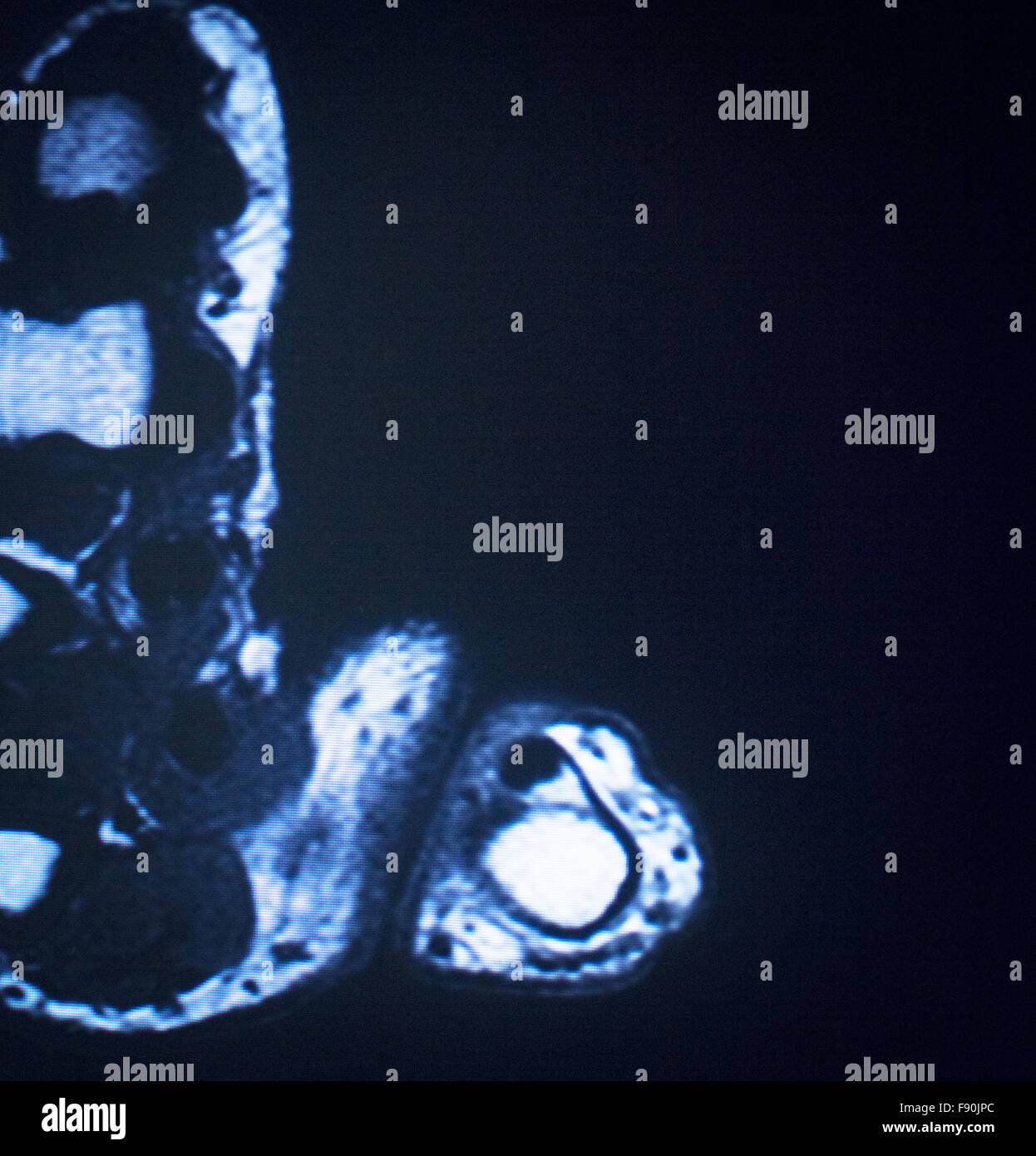 MRI magnetic resonance imaging medical scan test results of foot and ...