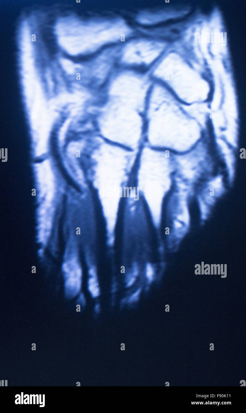 MRI magnetic resonance imaging medical scan test results of hand and ...
