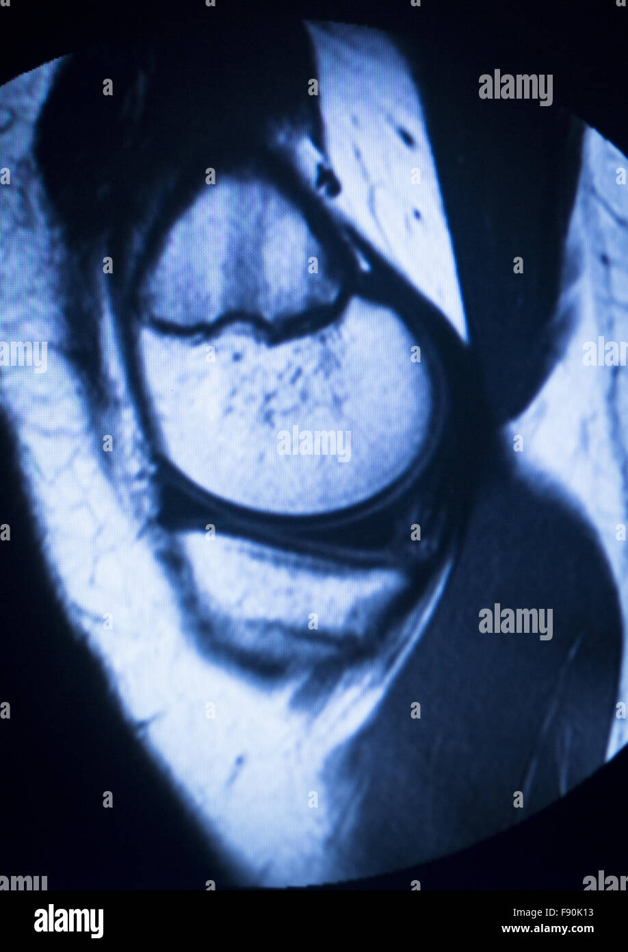 MRI magnetic resonance imaging medical scan test results showing knee ...