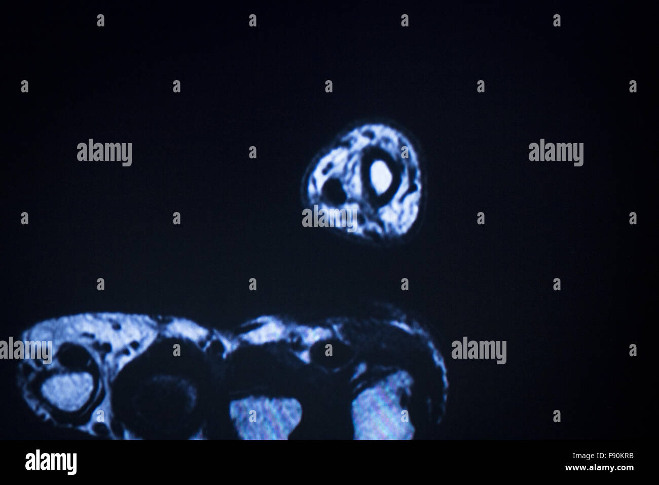 MRI magnetic resonance imaging medical scan test results of foot and ...