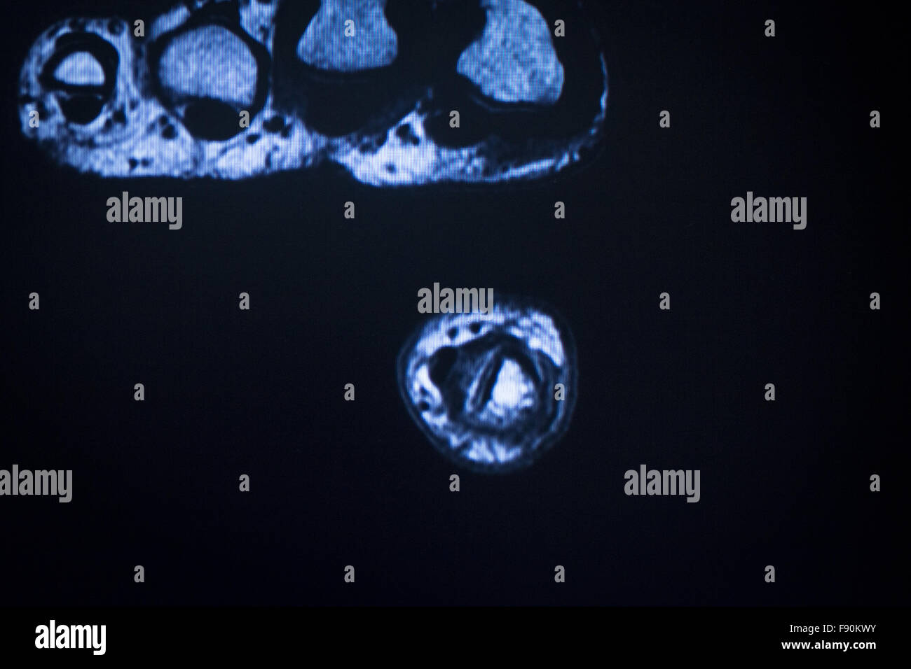 MRI magnetic resonance imaging medical scan test results of foot and ...