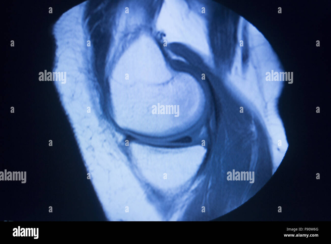 Mri Scanning Knee And Leg High Resolution Stock Photography and Images ...