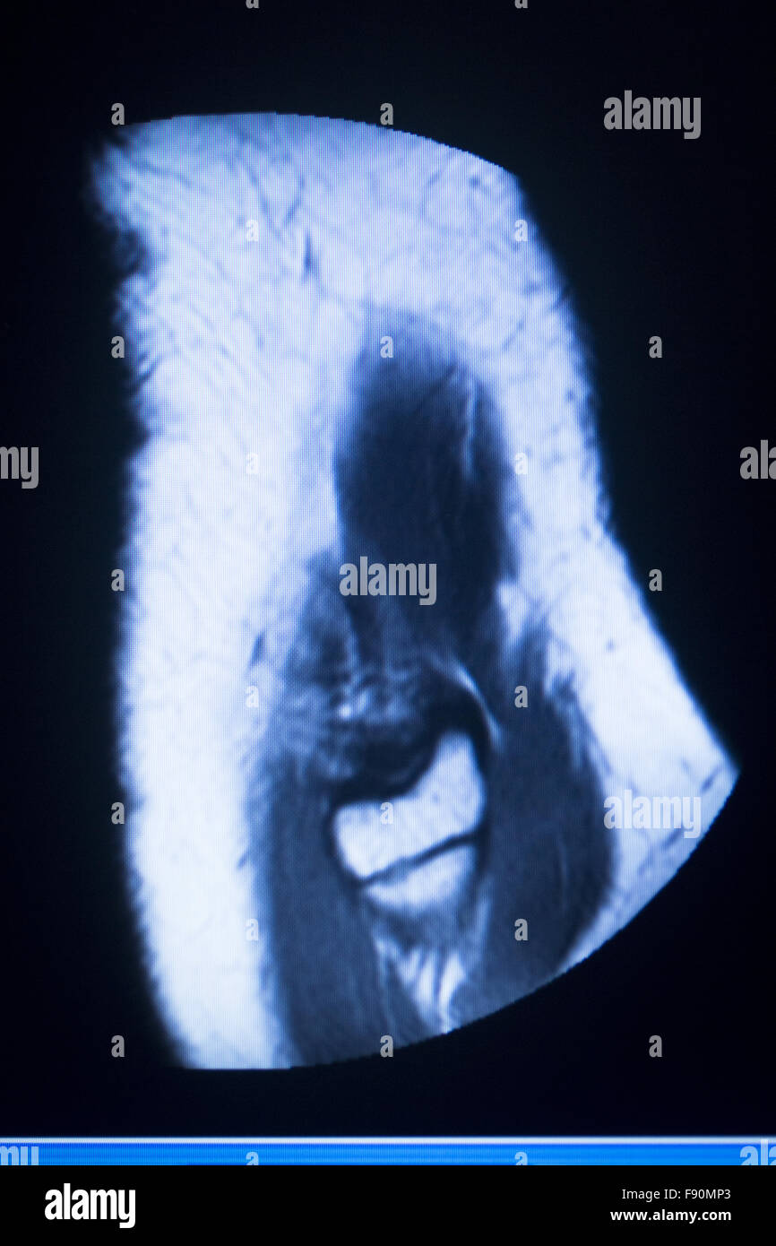 MRI magnetic resonance imaging medical scan test results showing knee ...