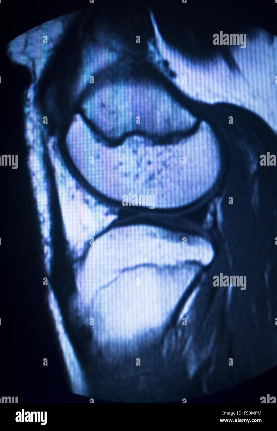 MRI magnetic resonance imaging medical scan test results showing knee ...