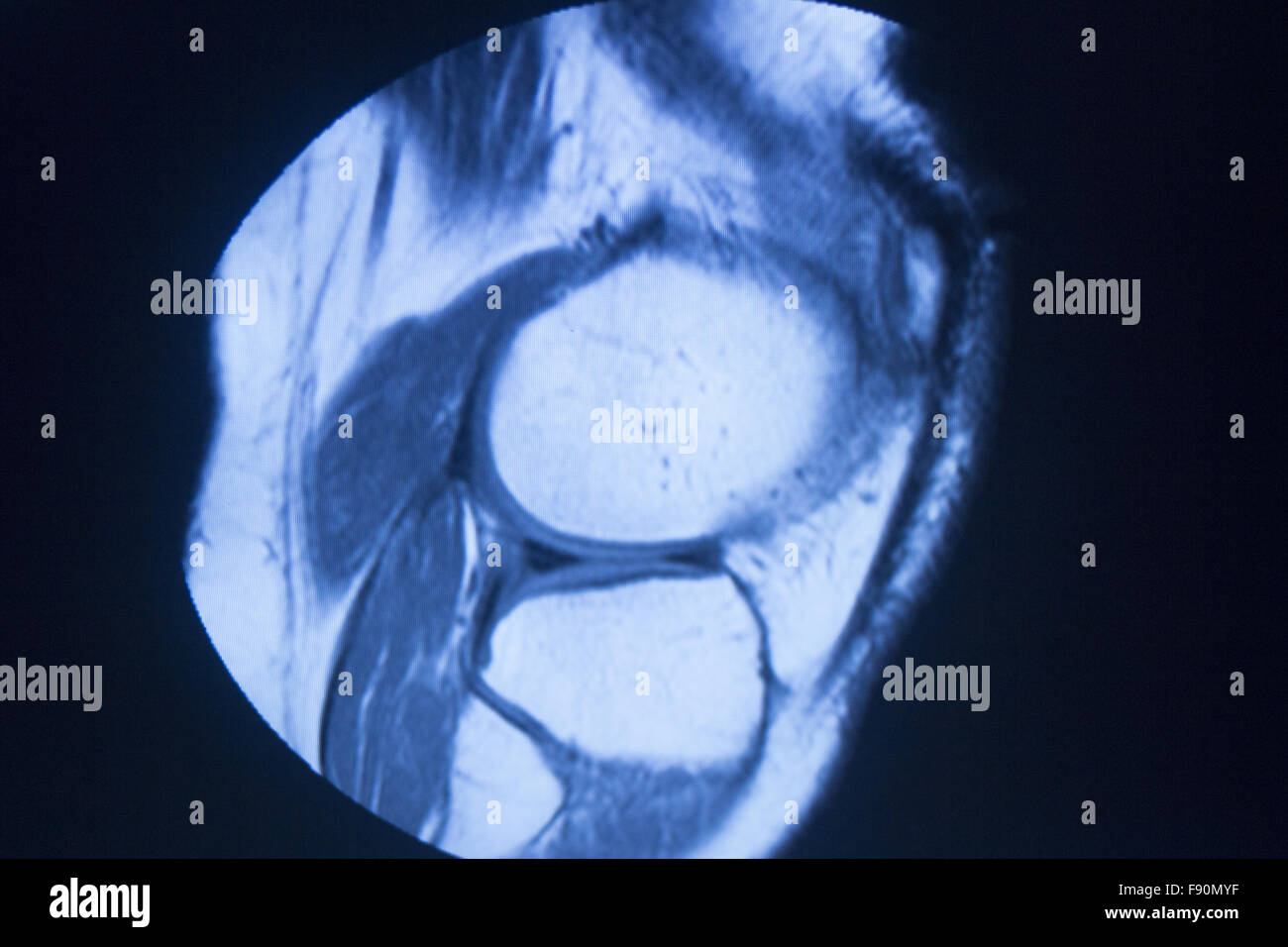 MRI magnetic resonance imaging medical scan test results showing knee ...