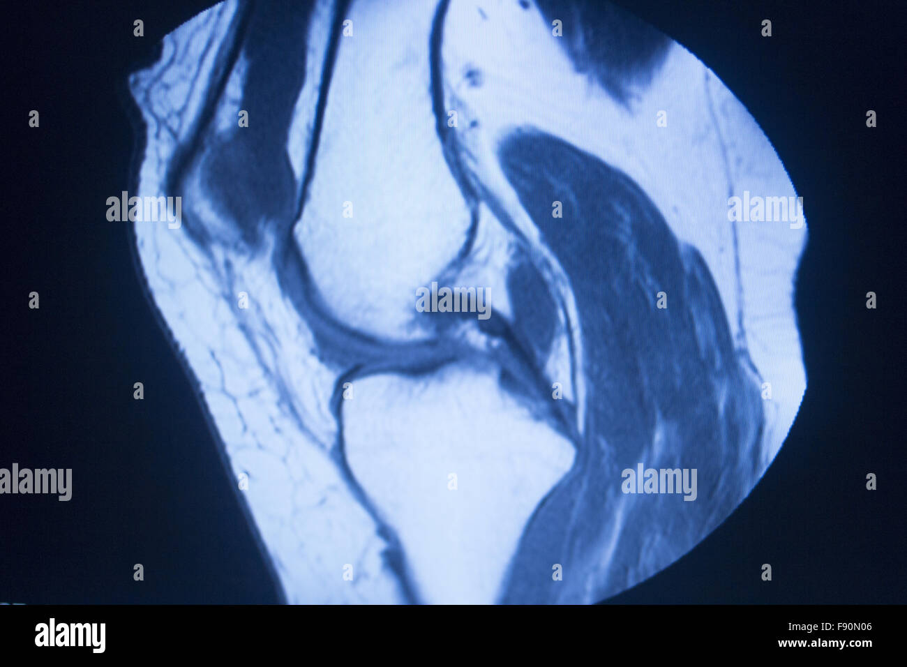 MRI magnetic resonance imaging medical scan test results showing knee ...