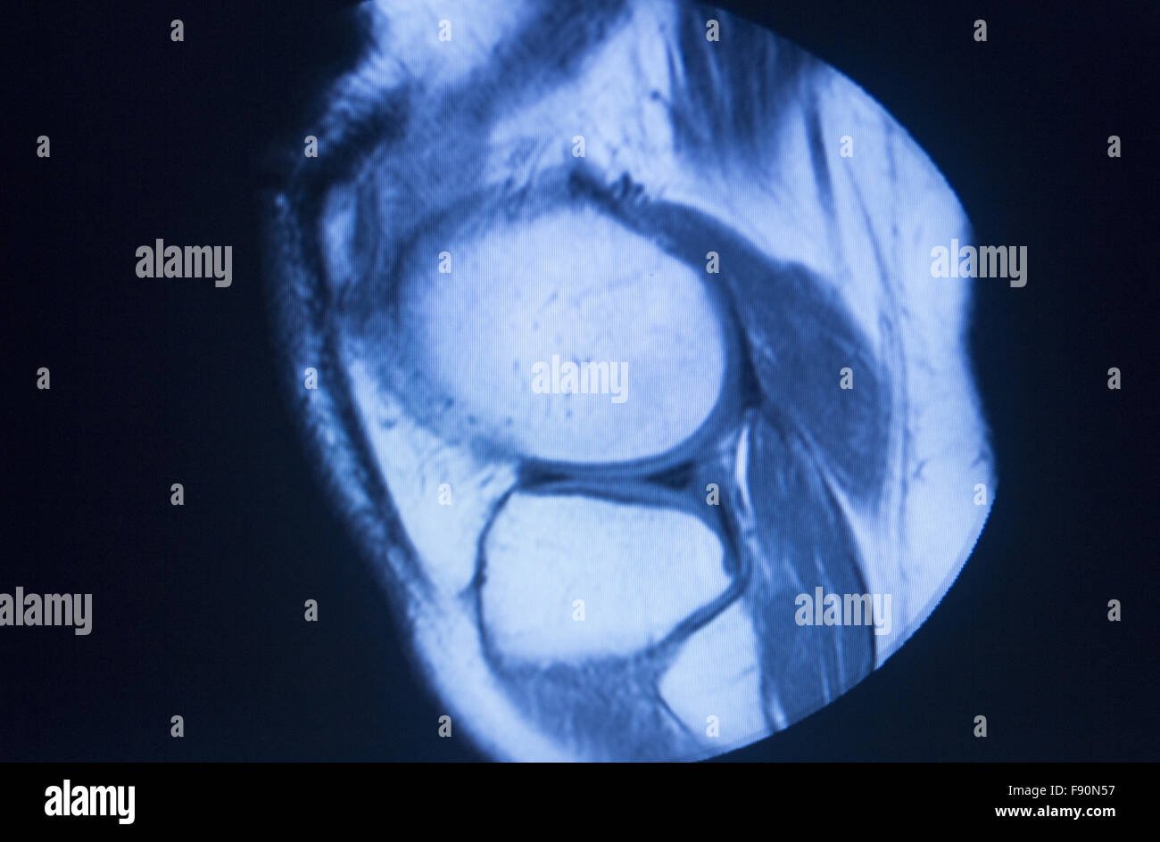 MRI magnetic resonance imaging medical scan test results showing knee ...