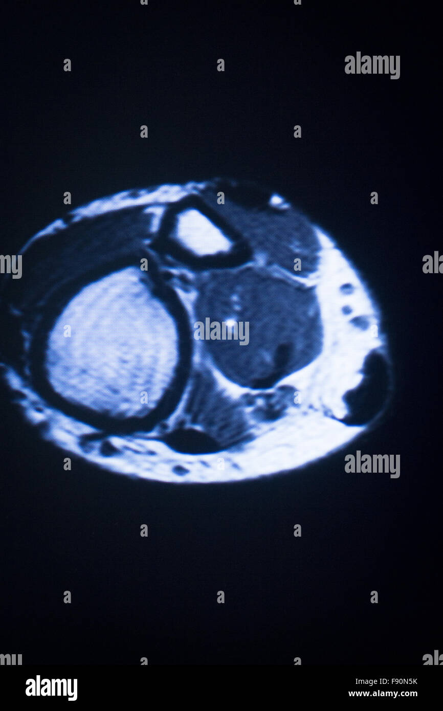 MRI magnetic resonance imaging medical scan test results showing ...