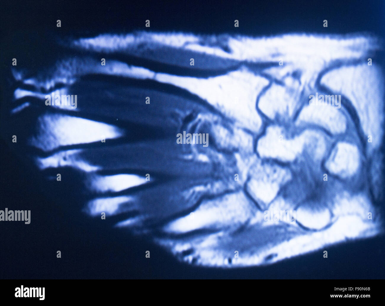 MRI magnetic resonance imaging medical scan test results of hand and ...