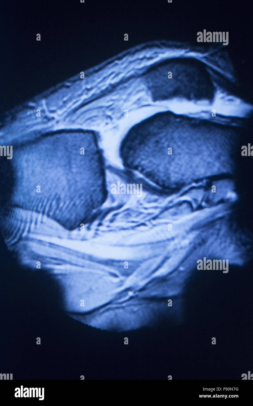 MRI magnetic resonance imaging medical scan test results showing knee ...