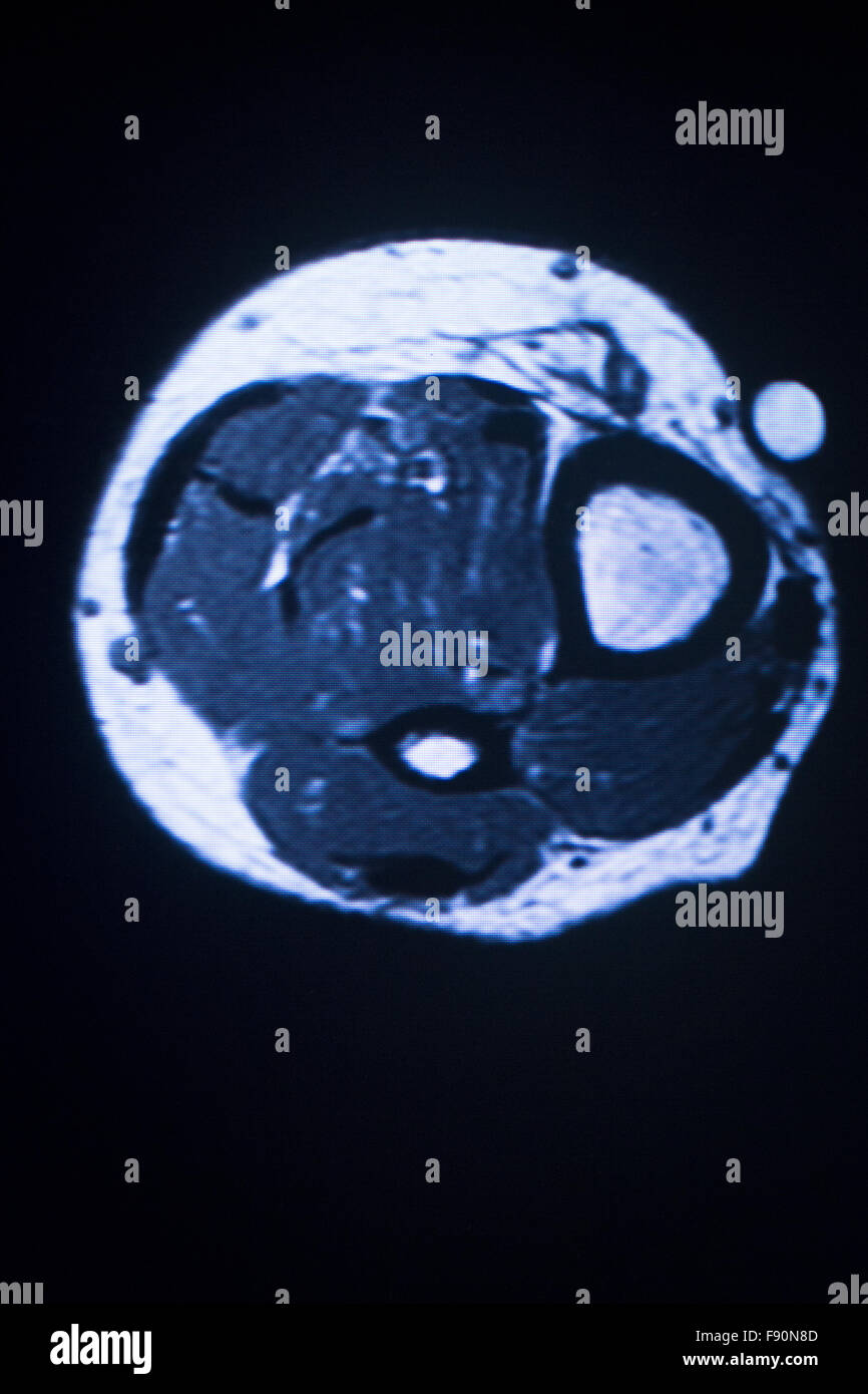 MRI magnetic resonance imaging medical scan test results showing ...