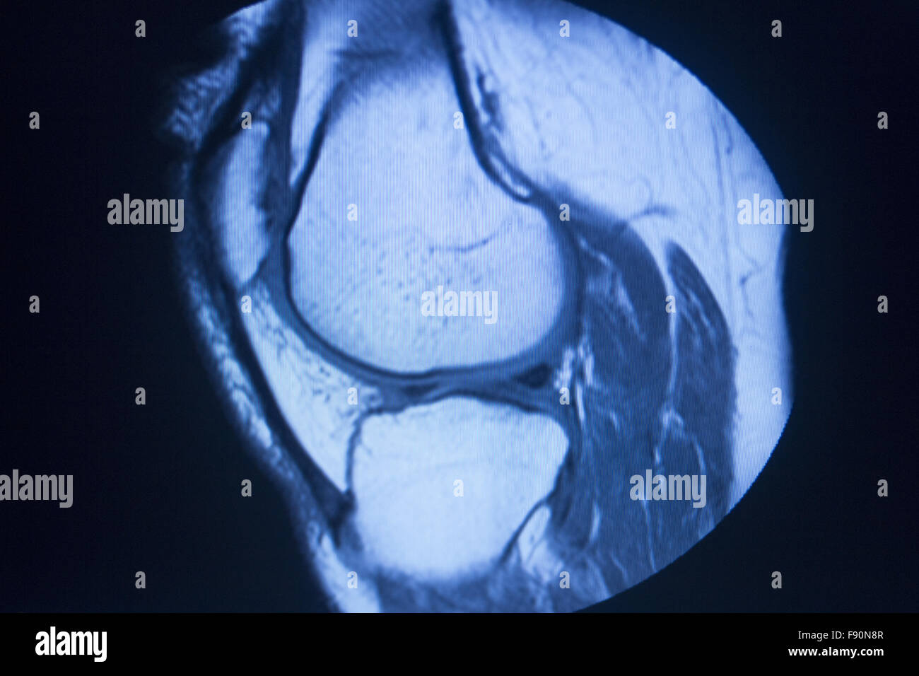 Mri Scanning Knee And Leg High Resolution Stock Photography and Images ...