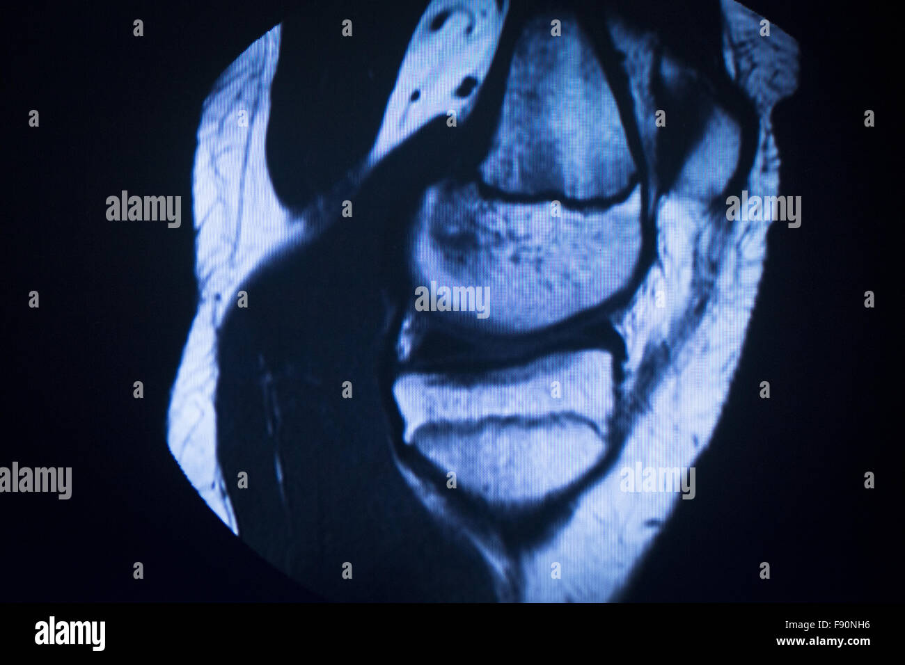 MRI magnetic resonance imaging medical scan test results showing knee ...