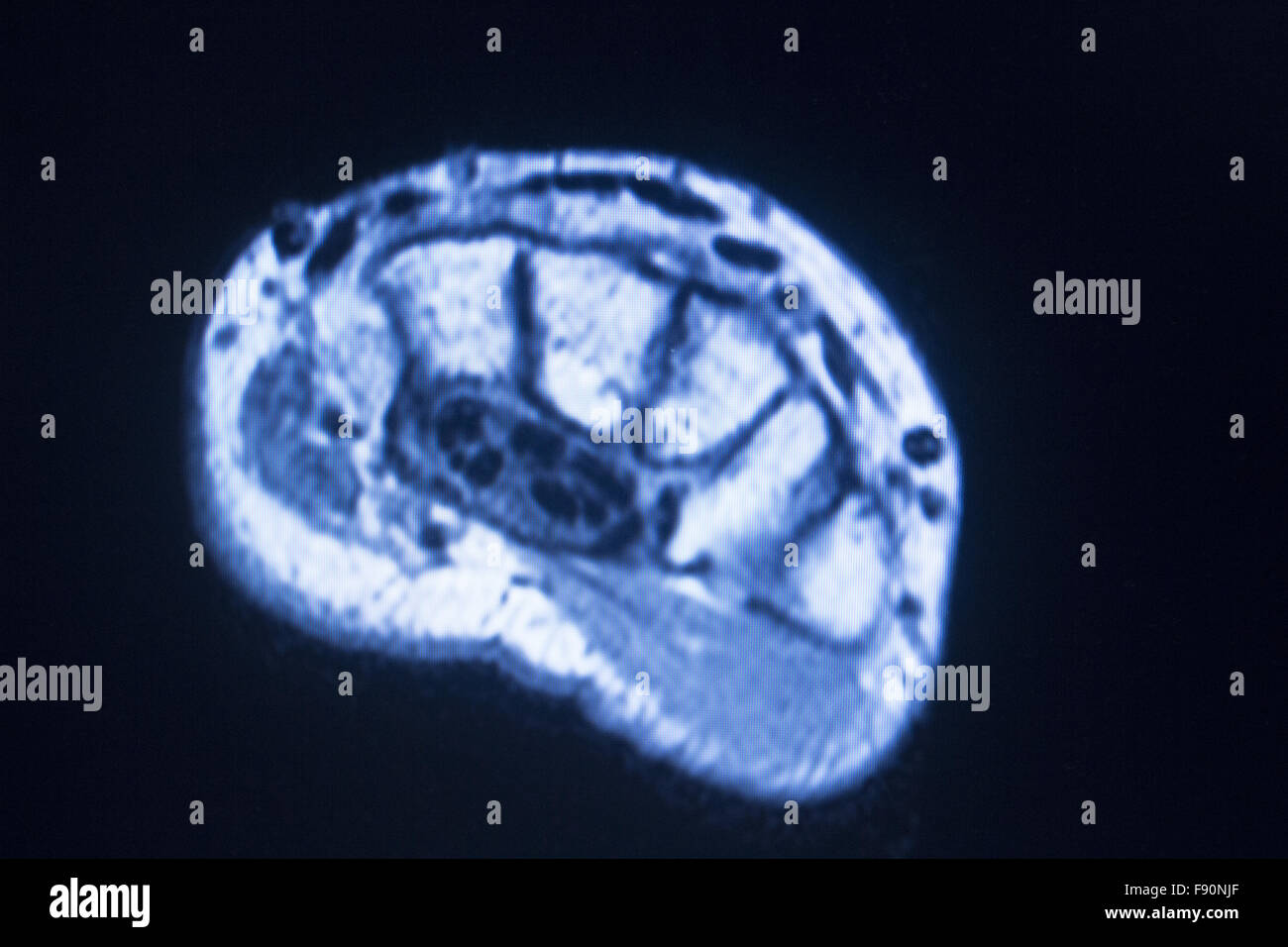 MRI magnetic resonance imaging medical scan test results of hand and ...