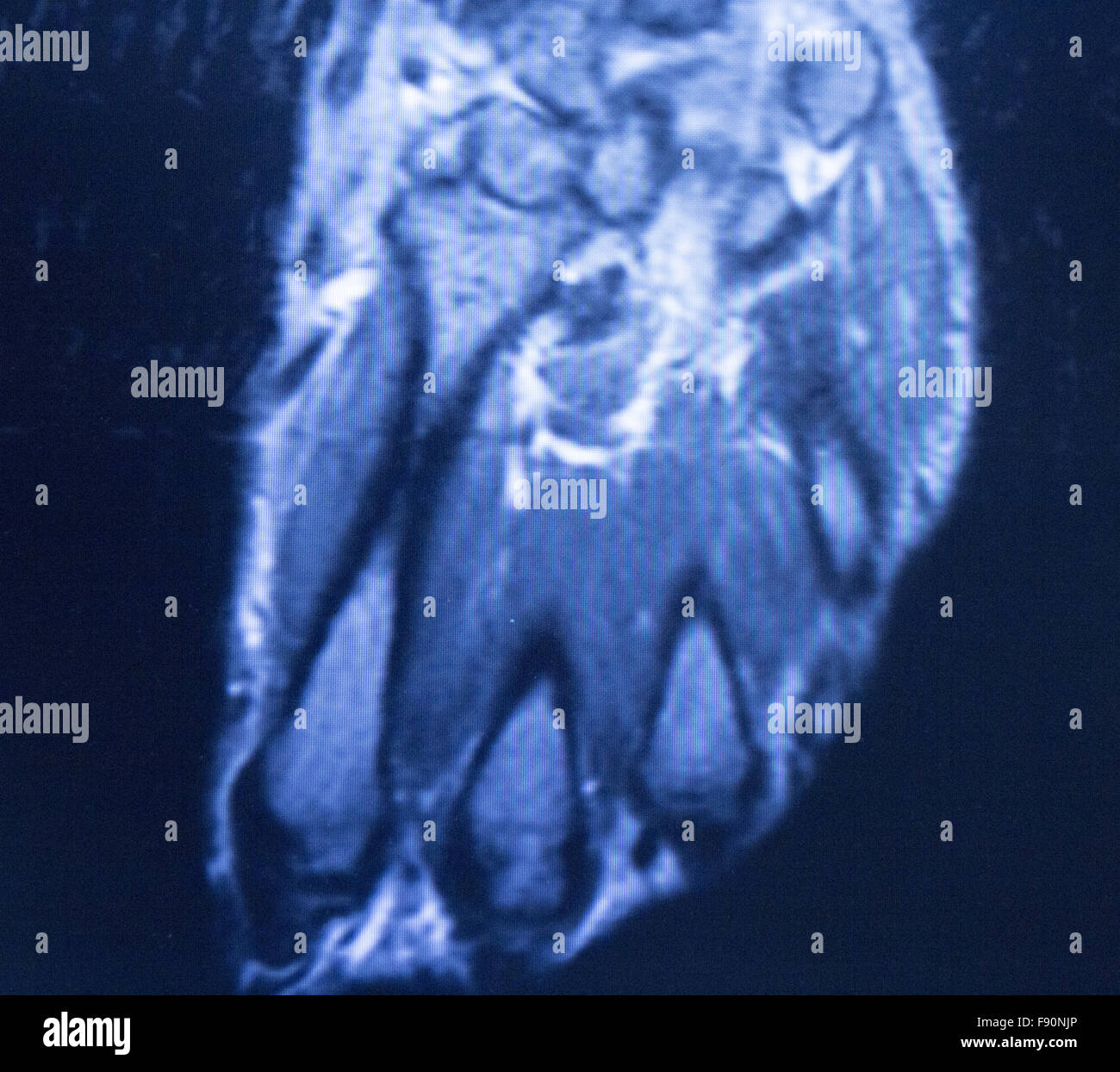 MRI magnetic resonance imaging medical scan test results of hand and ...