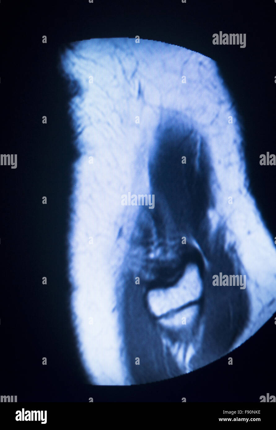 MRI magnetic resonance imaging medical scan test results showing knee ...