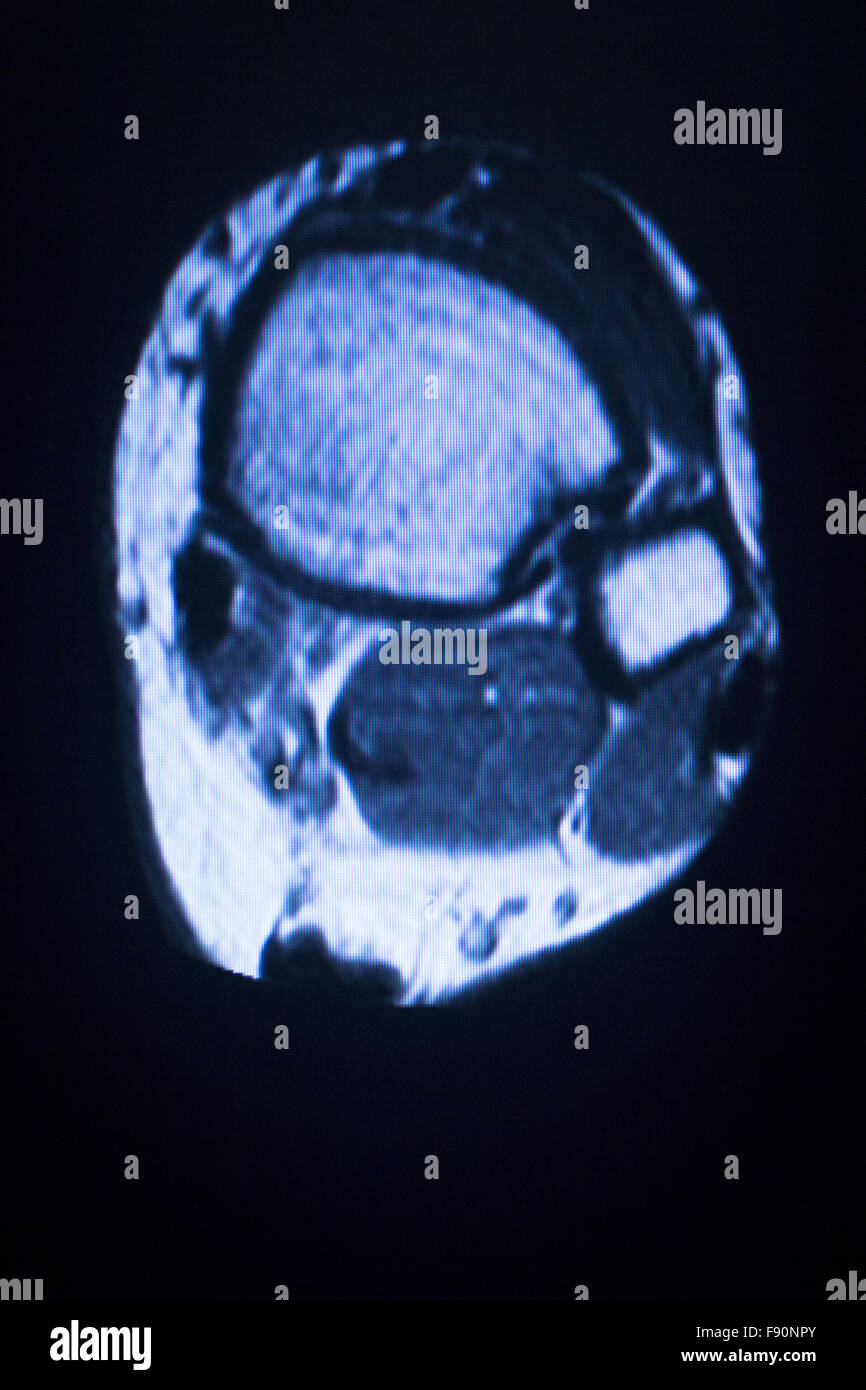 MRI magnetic resonance imaging medical scan test results showing ...