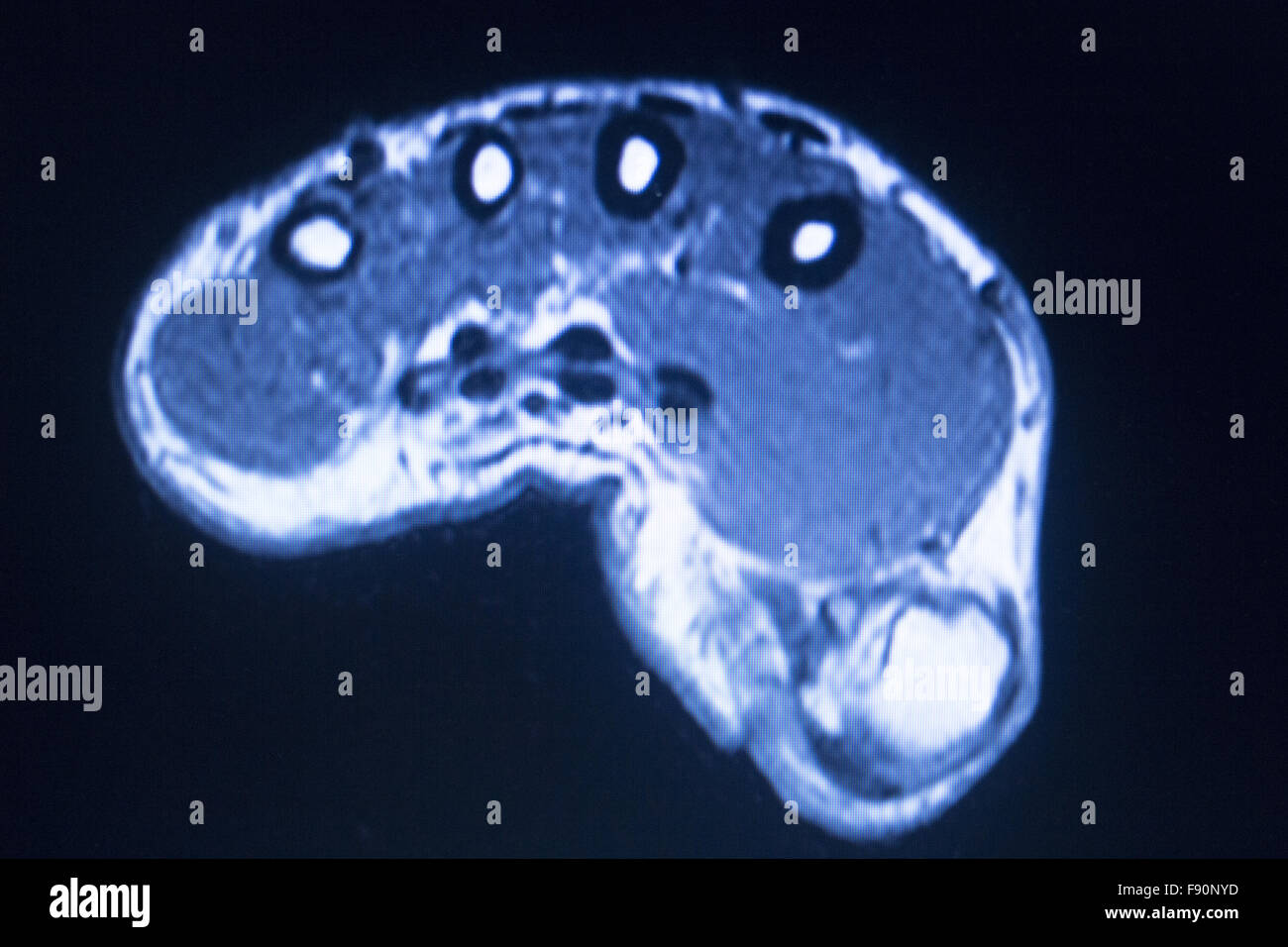 MRI magnetic resonance imaging medical scan test results of hand and ...