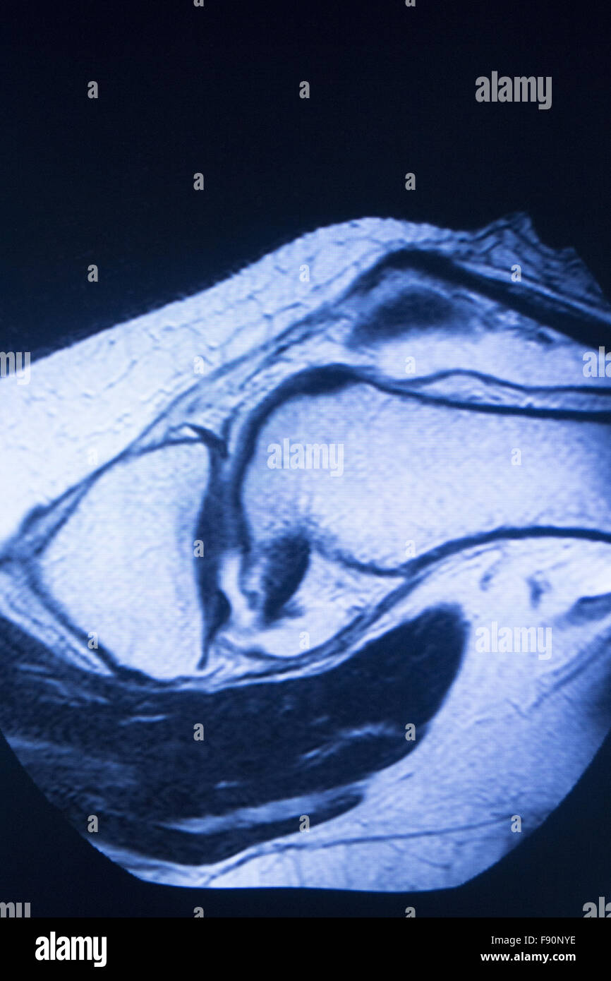 MRI magnetic resonance imaging medical scan test results showing knee ...