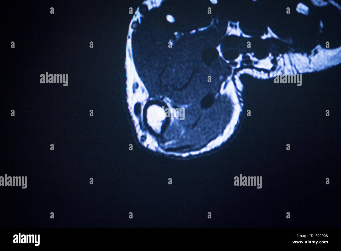 MRI magnetic resonance imaging medical scan test results of foot and ...