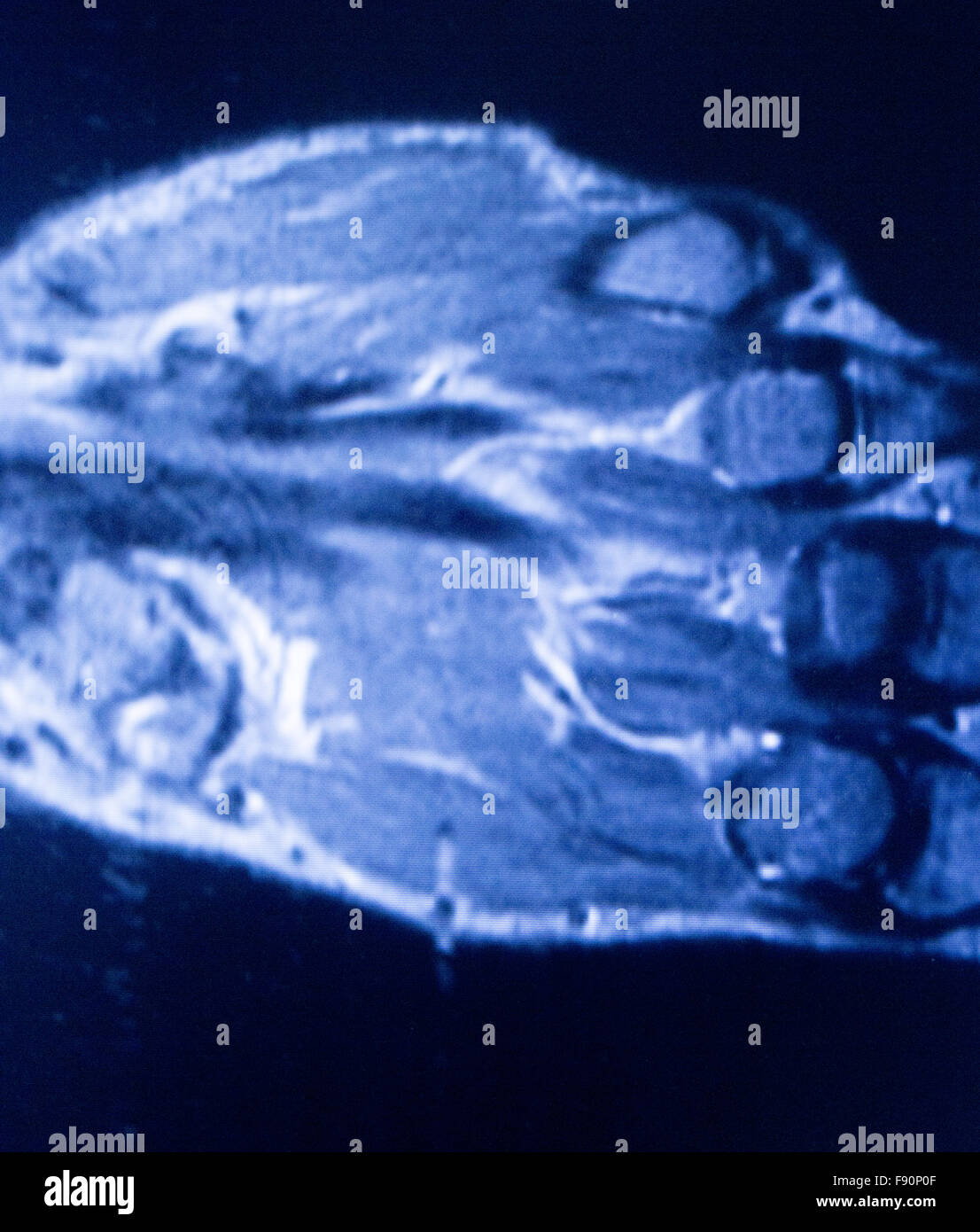 MRI magnetic resonance imaging medical scan test results of hand and ...