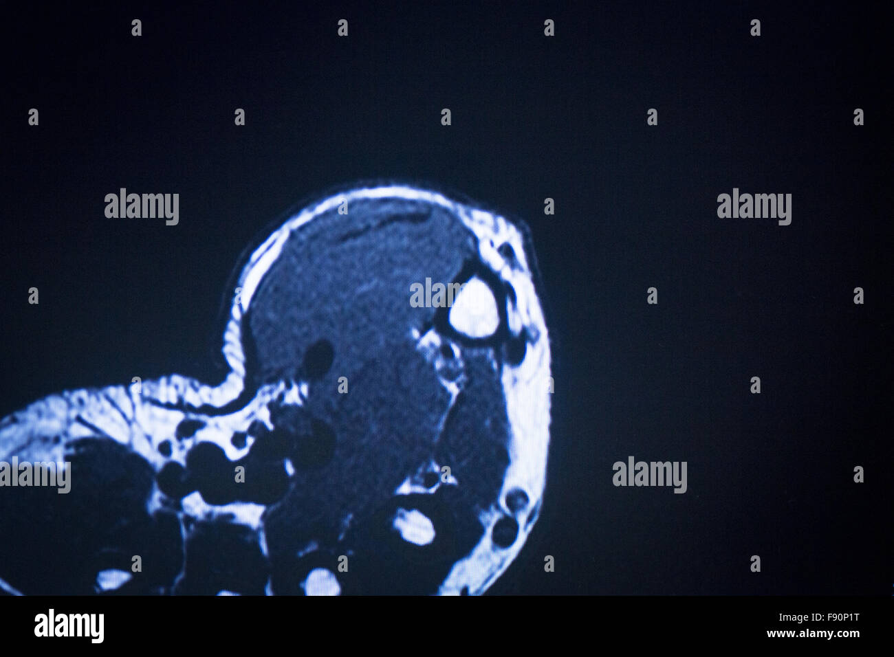MRI magnetic resonance imaging medical scan test results of foot and ...