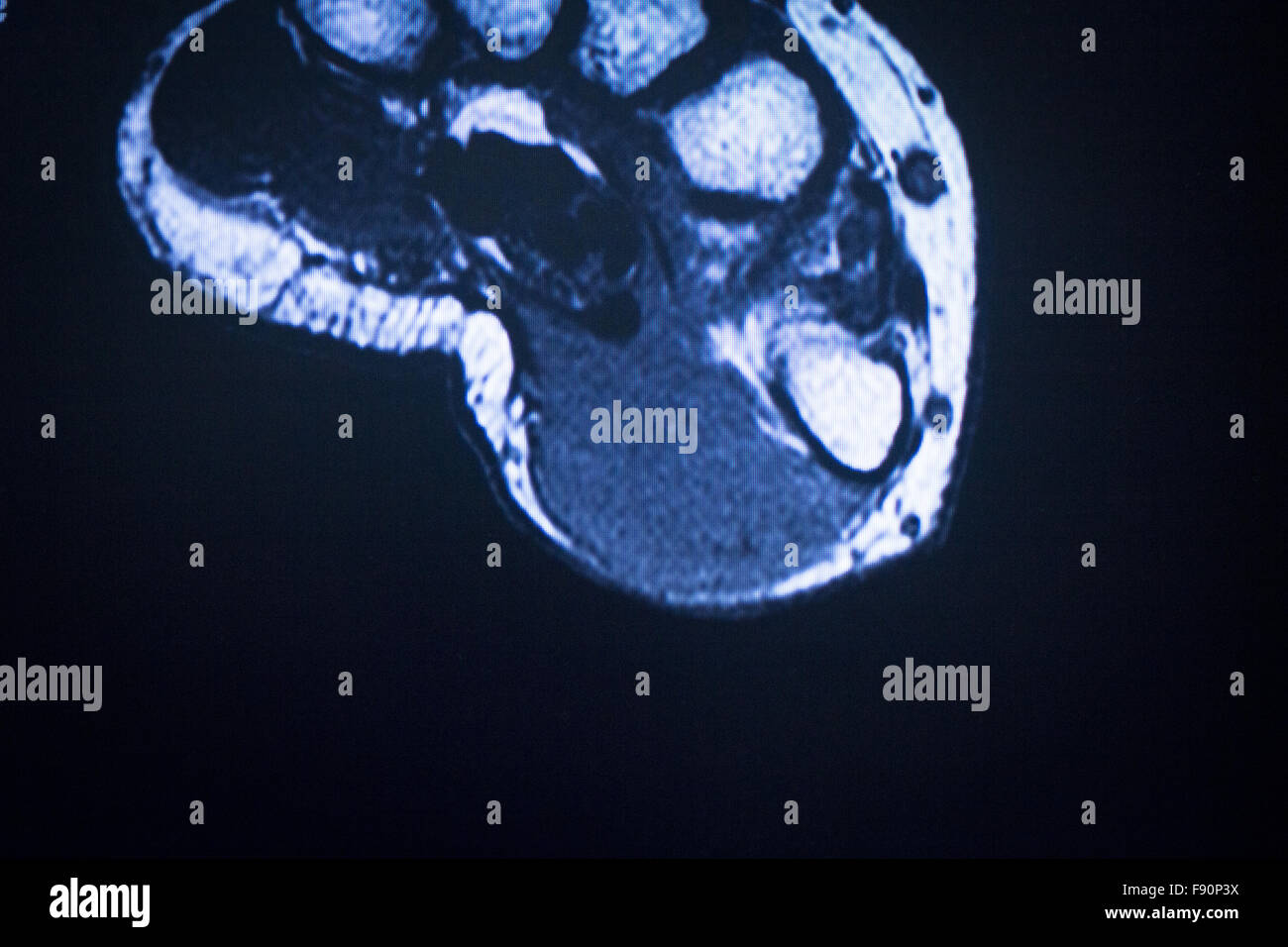 MRI magnetic resonance imaging medical scan test results of foot and ...