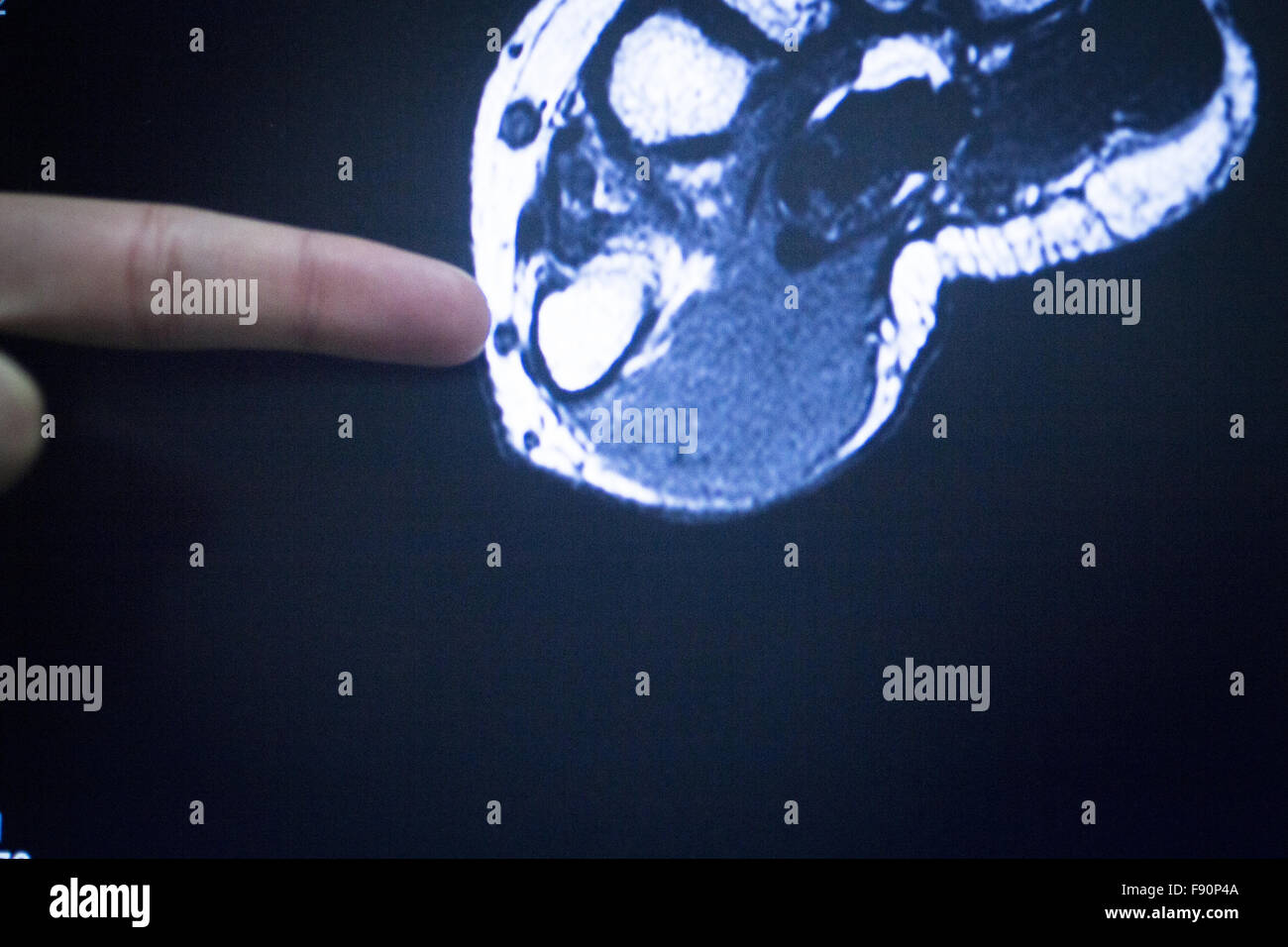 MRI magnetic resonance imaging medical scan test results of foot and ...
