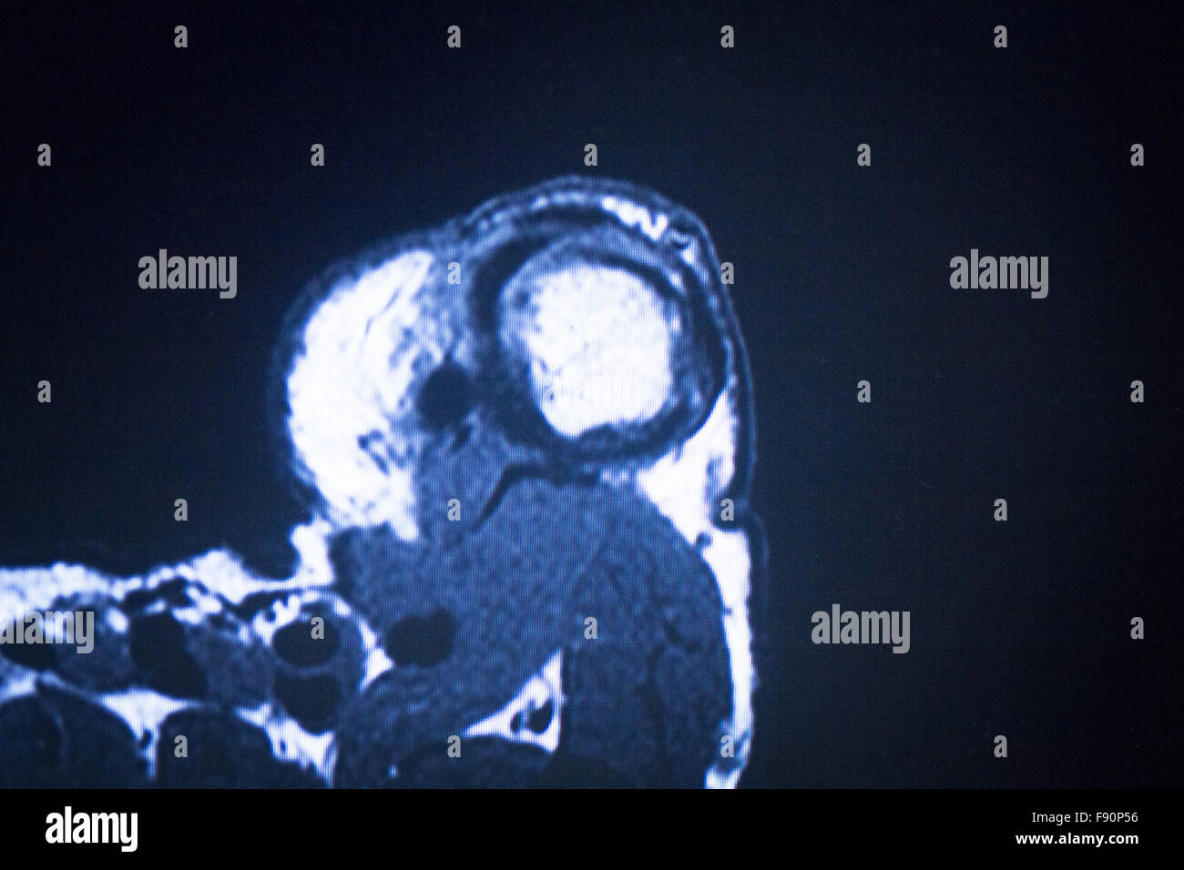 MRI magnetic resonance imaging medical scan test results of foot and ...