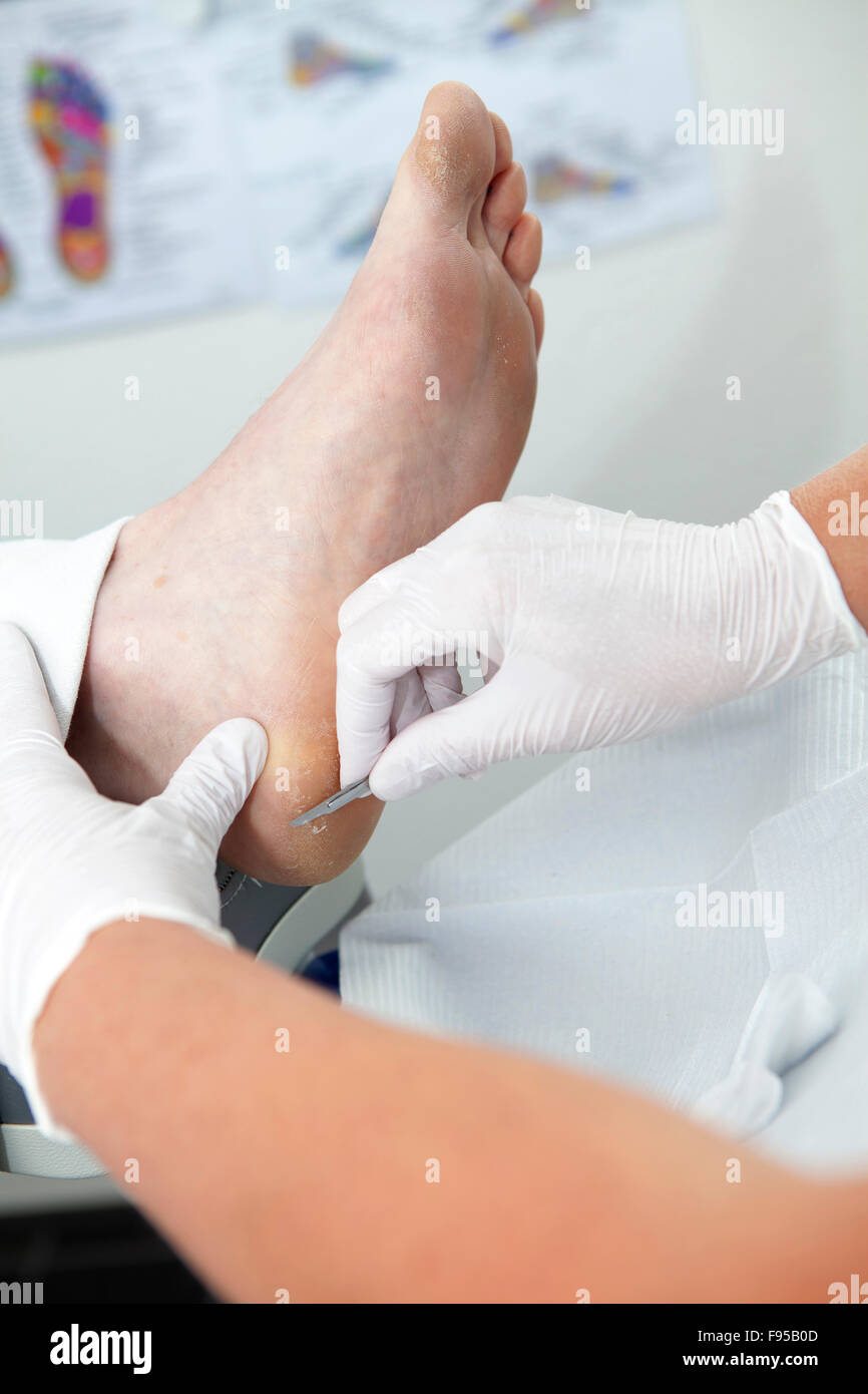 Removing dry callas of feet in closeup Stock Photo - Alamy