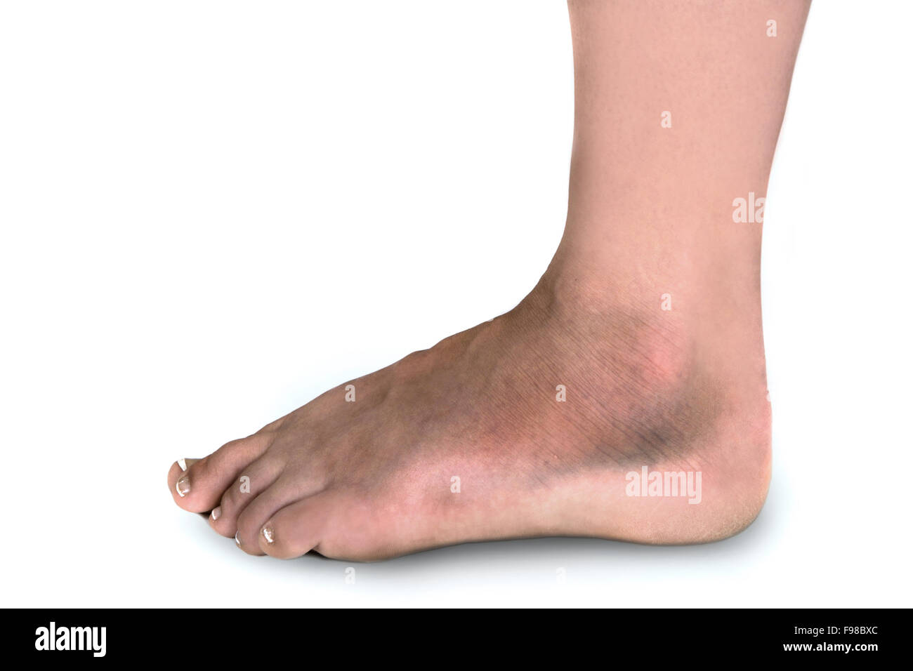 Woman With Broken Foot Stock Photo - Alamy